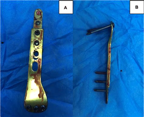 What Is A Internal Fixation Device At Michael Doxey Blog