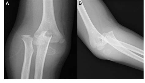 Figure 1 From Anterior Transolecranon Fracture Dislocation With An Associated Avulsion Fracture