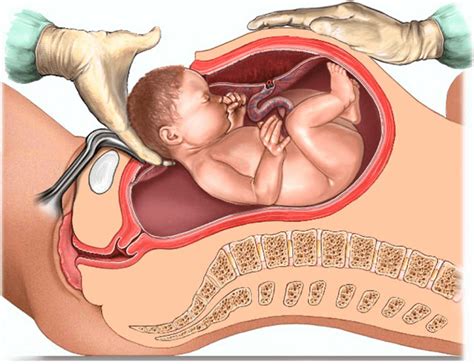 Cesarean Section Procedure
