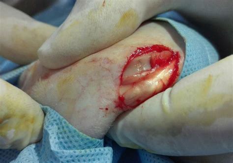 Photographs Show The Full Thickness Articular Cartilage Defect Created Download Scientific