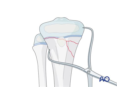 Open Reduction Plate Fixation For Epiphysiolysis With Metaphyseal Wedge Salter Harris Ii