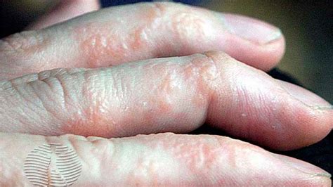Hives On Fingers Only