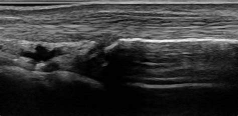 Musculoskeletal Joints And Tendons 6 3 Wrist And Carpus Case 6 3 1 Tenosynovitis Of The