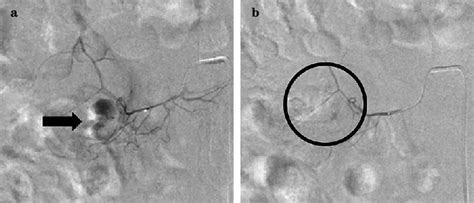 Angiography Of The Inferior Pancreaticoduodenal Artery Revealed