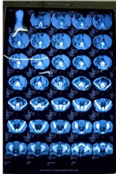 Ct Abdomen Liver Caudate Lobe Hypertrophied Segments 23and 67