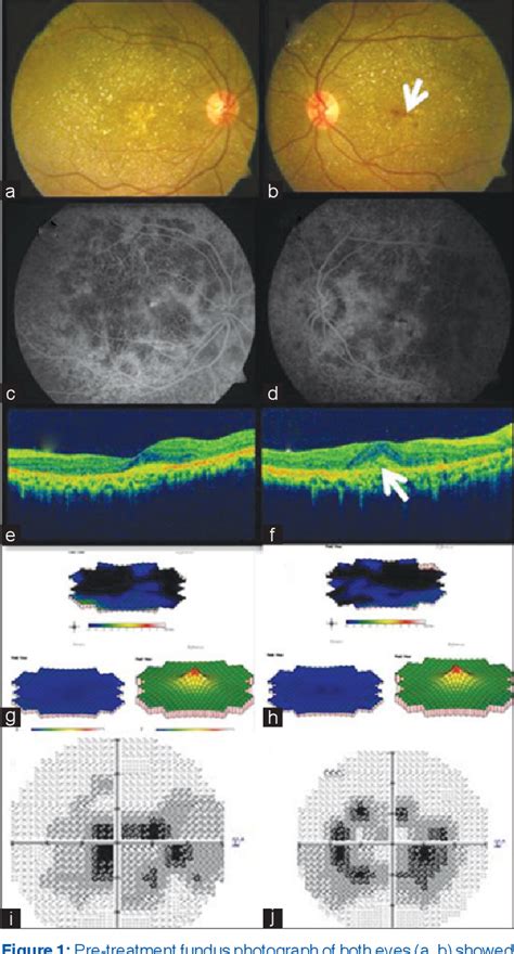 Figure 1 From Ranibizumab For Choroidal Neovascular Membrane In A Rare