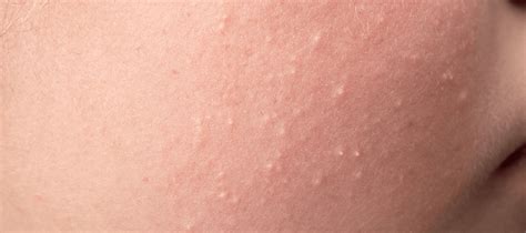 Understanding Small Bumps On Face Not Acne But What Are They The