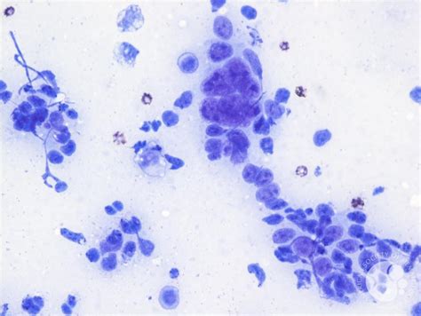 Touch Prep Hodgkin Lymphoma