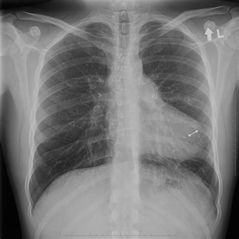 Valve Replacement Chest X Ray At Rickey Park Blog