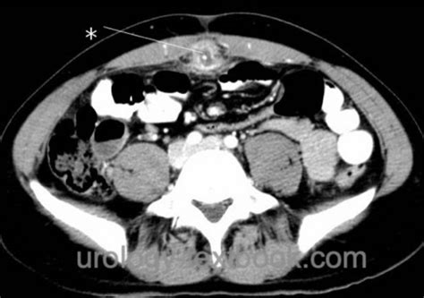 Patent Urachus And Urachal Cysts Diagnosis And Treatment