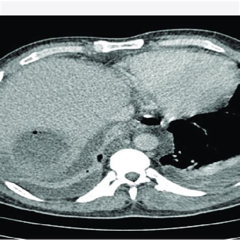 Liver Abscess In The Left Lobe Poorly Defined Walls Presence Of