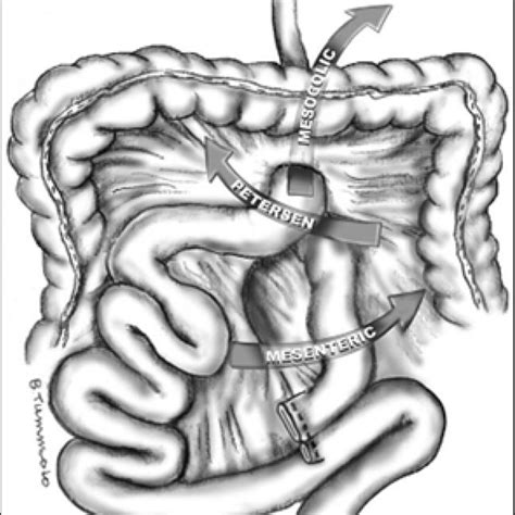 A Internal Hernia Through The Jejunal Mesenteric Defect And B The Download Scientific Diagram