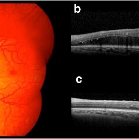 A Fundus Photography Showing Choroidal Melanoma Before The Treatment Download Scientific
