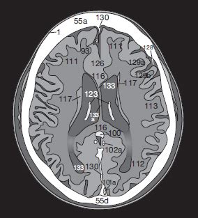 Cranial CT Normal Findings Radiology Key