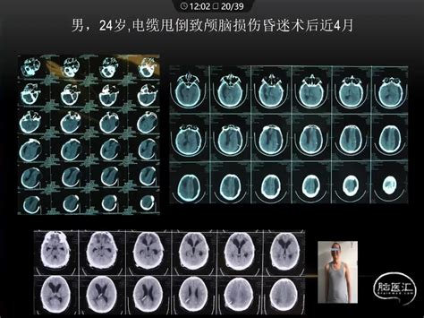 吴雪海教授：被低估的临床低颅压 脑医汇