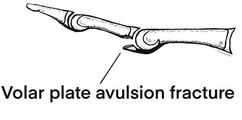 Volar Plate Avulsion Fracture Web James Henderson Specialist
