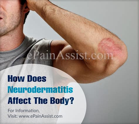 How Does Neurodermatitis Affect The Body Picture
