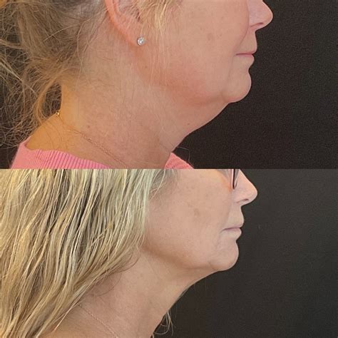 Coolsculpting Faqs What Arizona Patients Should Know