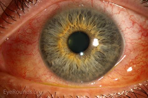 Atlas Entry Bilateral Chemosis In Thyroid Eye Disease