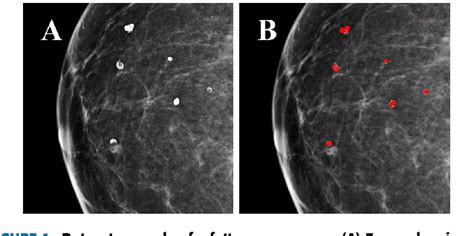 table 1 from an automated breast micro calcification detection and