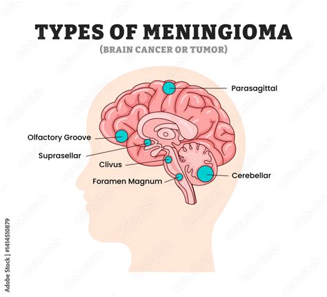 Стоковое векторное изображение Different Types Of Meningioma Types
