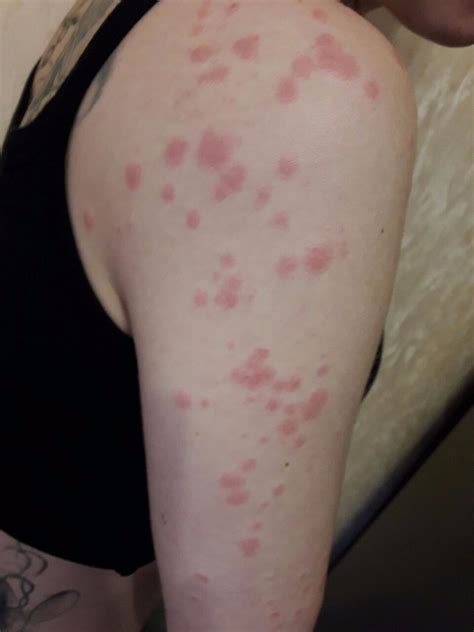 Пятна по телу Вопрос дерматологу 03 Онлайн