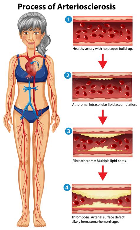 Premium Vector Process Of Arteriosclerosis Medical Illustration