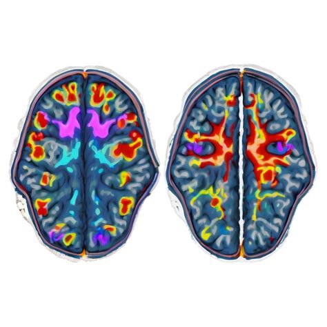 Download Functional Mri Brain Mapping Png Nhs