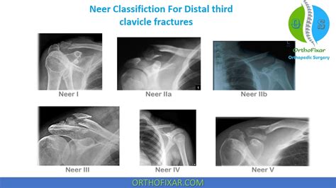 Proximal Clavicle Fracture