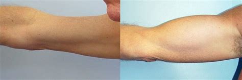 Before After Biceps 02 Gravity Medical Spa