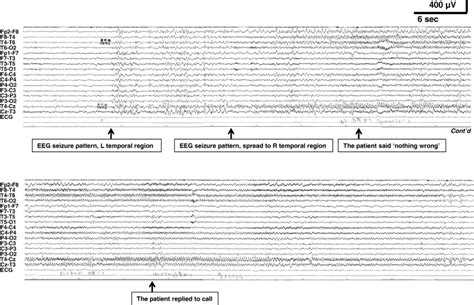 Ictal Eeg An Electroencephalographic Seizure Pattern Starting At The