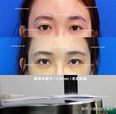 假体垫眉弓拆线时的切口和肿胀情况大概什么样？ 知乎