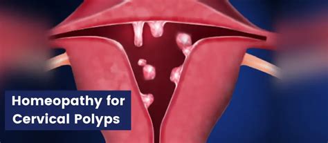 Cervical Polyps Symptoms Causes And Homeopathic Remedies