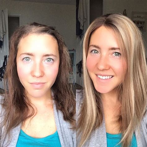 What Kind Of Wigs Suit Women With Thinning Hair