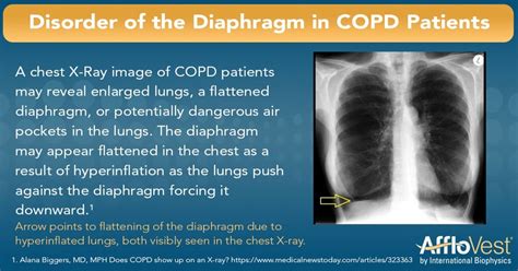 Chest X Ray Copd