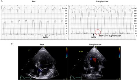 Waveform Recording Of The Intra‐left Ventricular Pressure And The Pcwp