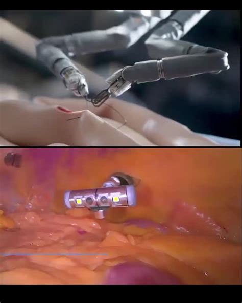 Farha Anjum On Linkedin Neurosurgicalcare Neurosurgery Delicate Challenging Medicine