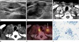 Supraclavicular Lymphadenopathy Ultrasound
