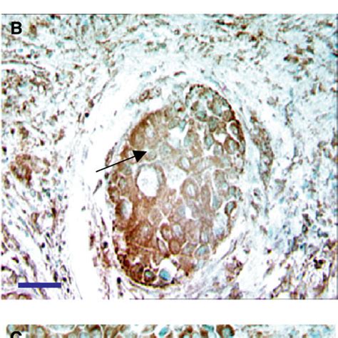Fibulin 1 Protein Expression In Normal Breast Tissue And Invasive Download Scientific Diagram