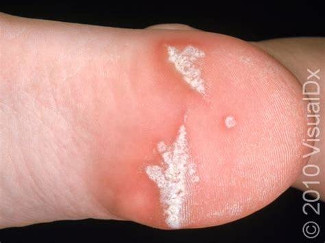 Plantar Warts Roots