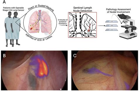 Frontiers Sentinel Lymph Node Detection For Lung Cancer Surgery A Possible Pathological