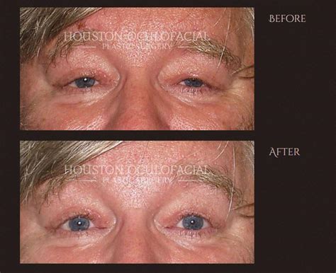 Botox Side Effects Droopy Eyelid
