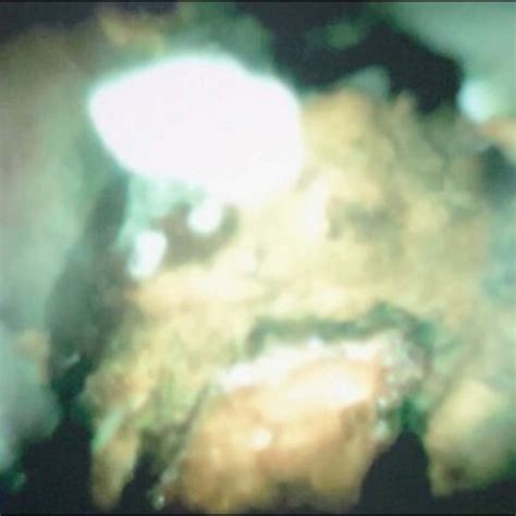 A Visualized Stone On Cholangioscopy Seen In The Distal Common Bile