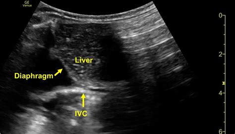 Practical Pocus On Linkedin Pocus Confirmation Of Intraosseous Line Placement Visualization Of…