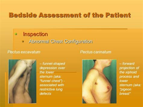 Pectus Excavatum