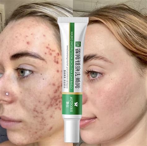 Крем для лечения акне угрей От прыщей для проблемной кожи лица угревой сыпи Лечение шрамов