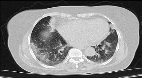 Thorax Ct Image Parenchymal Window Of Patient 14 Shows Bilateral