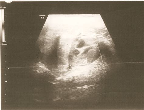 A Unique Presentation Of Ectopic Thyroid Tissue Case Report And Management Principles R Medizzy