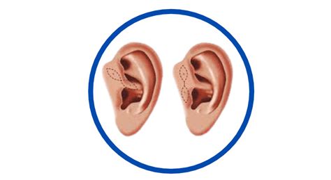 Preauricular Sinus Surgery Cost Save 10 Surgical Cost