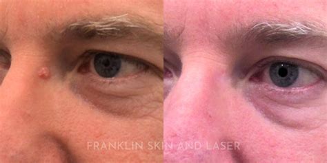 Skin Cancer Removal Before And After Photos In Franklin